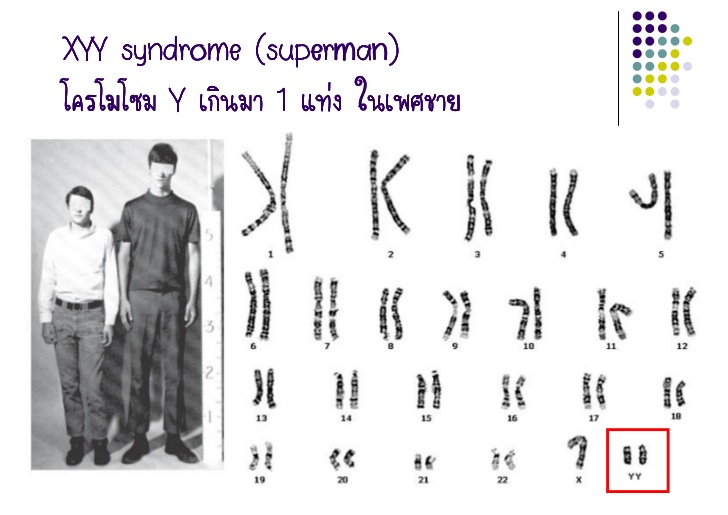 Xyy syndrome Toptenz